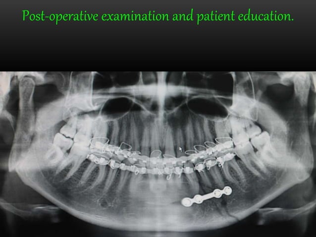 OPG and Extraoral radiography | PPTX