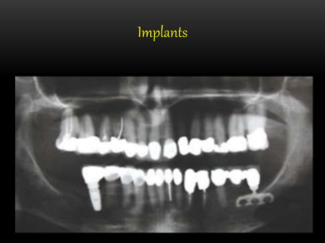OPG and Extraoral radiography | PPTX