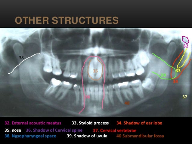 OPG and Extraoral radiography