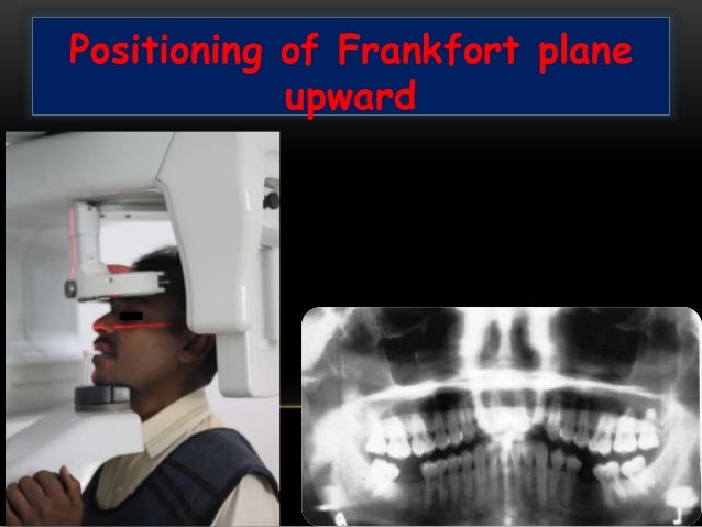 OPG and Extraoral radiography