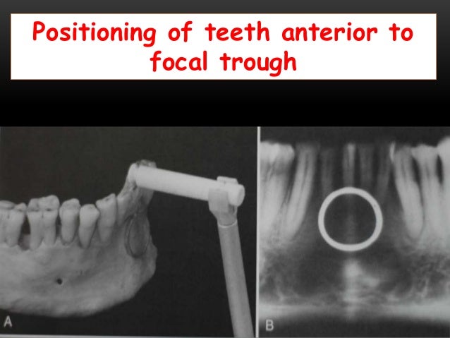 OPG and Extraoral radiography