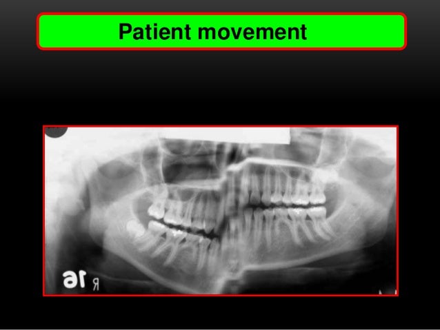 OPG and Extraoral radiography
