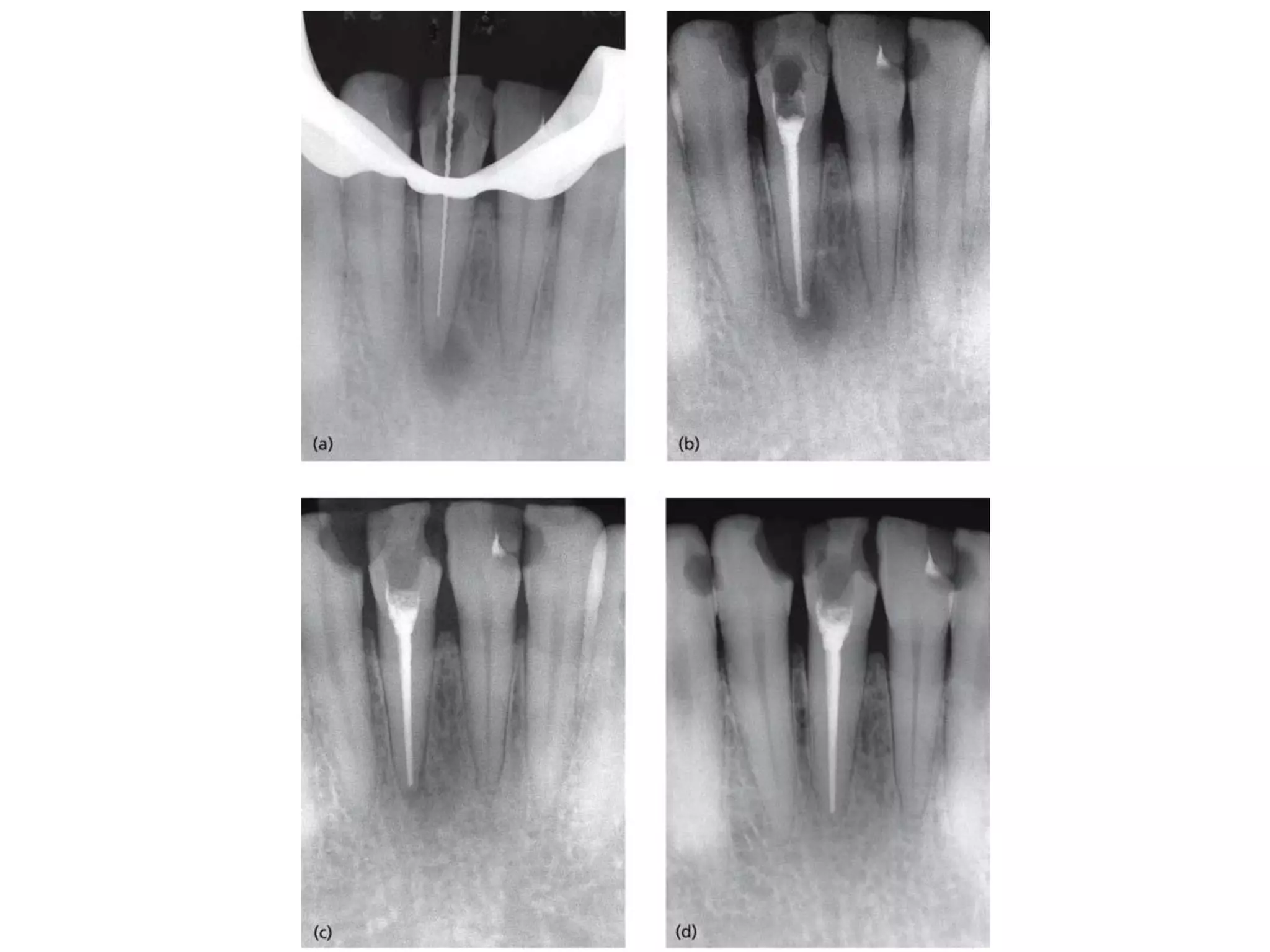 Radiographs in endodontics | PDF