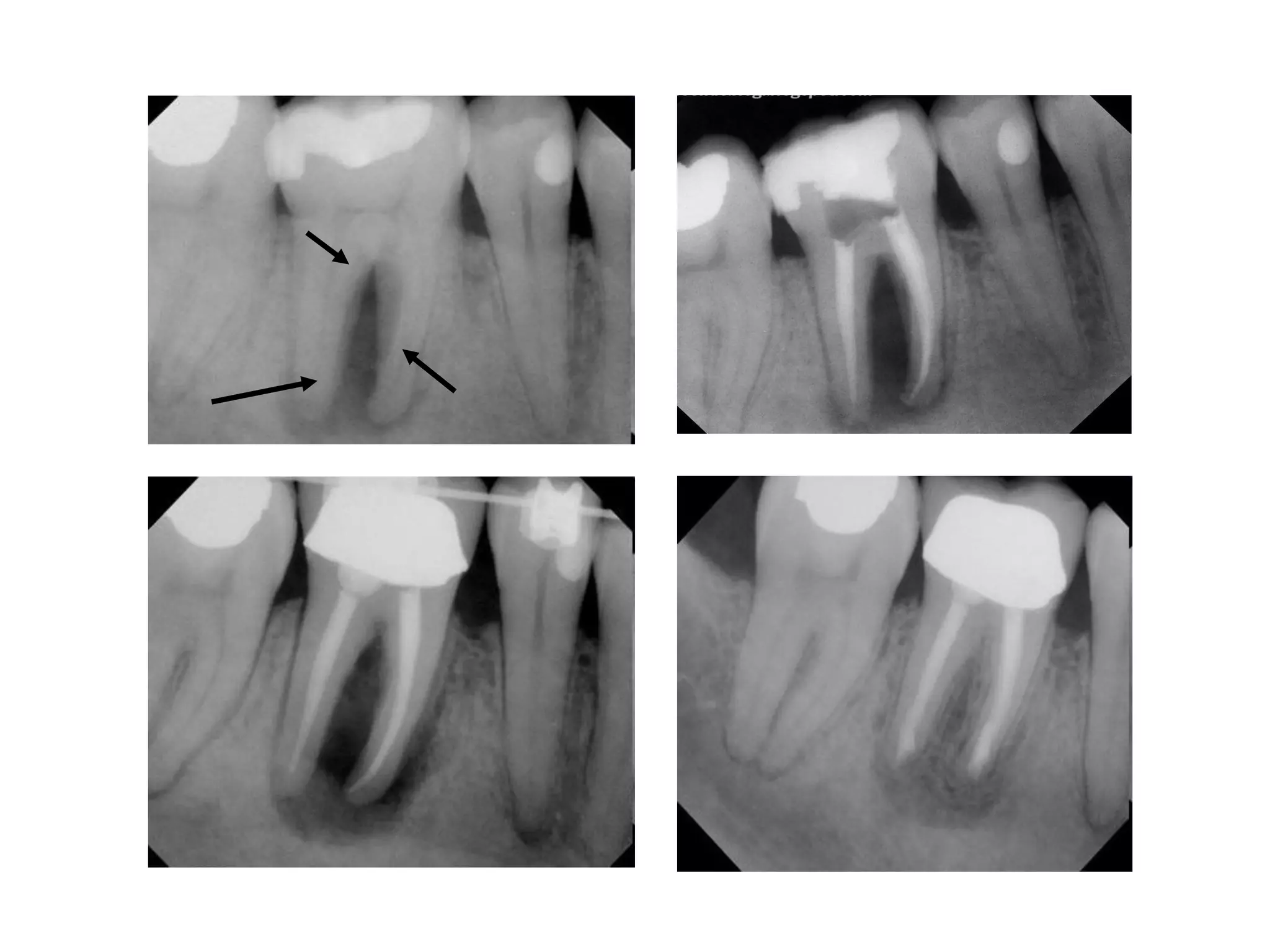 Radiographs in endodontics | PDF