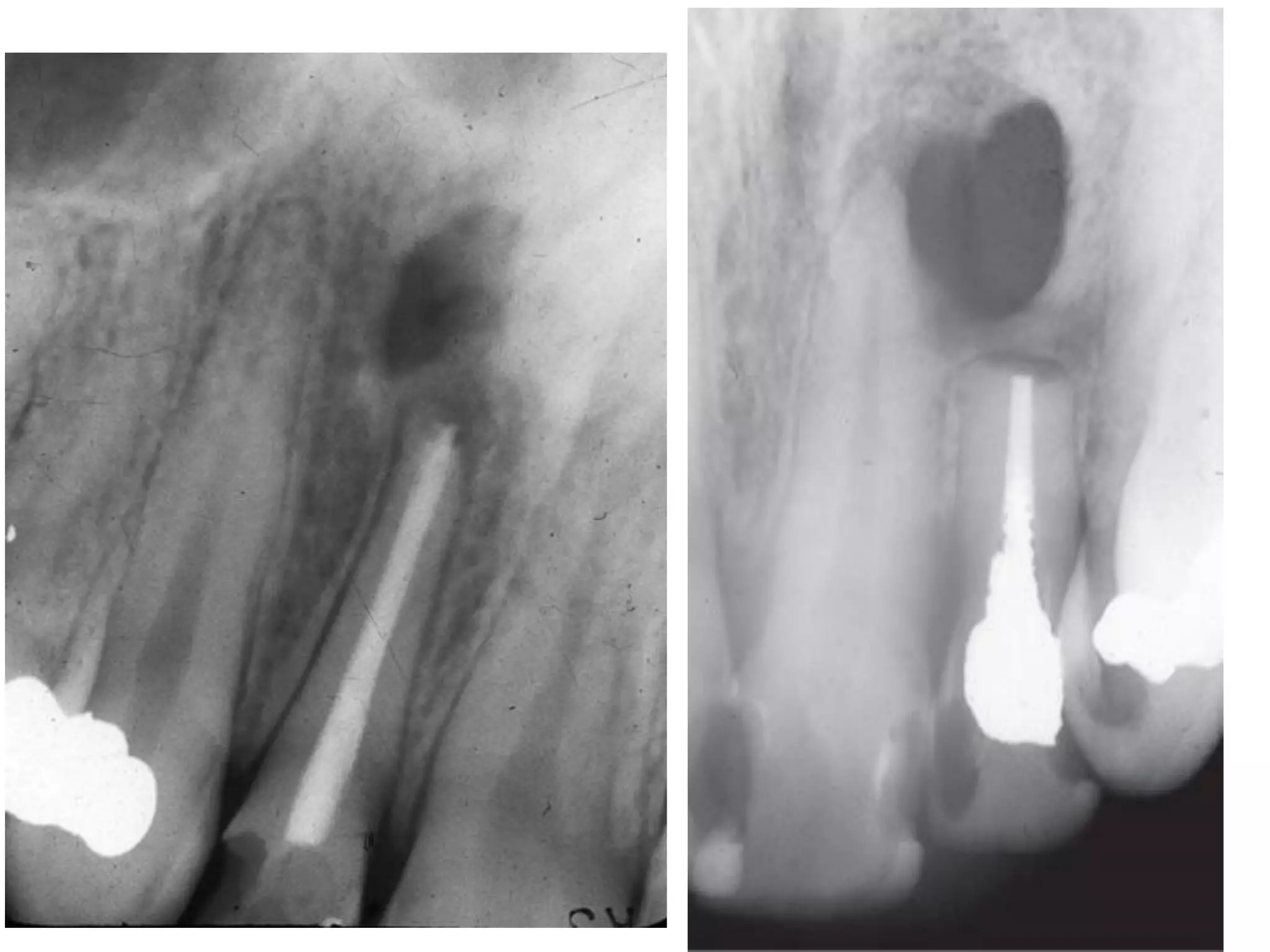 Radiographs in endodontics | PDF
