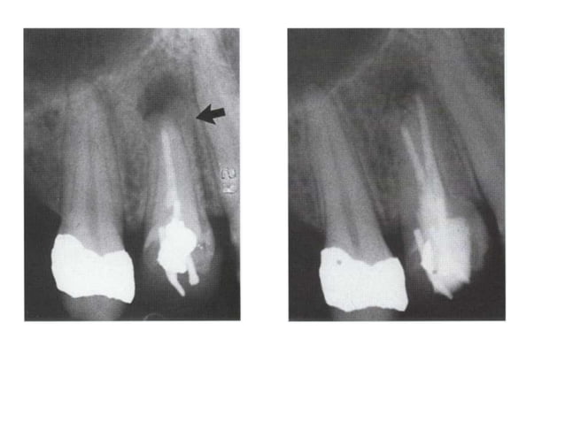 Radiographs in endodontics | PDF | Dental Health | Diseases and Conditions
