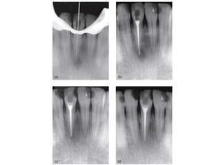 Radiographs in endodontics | PDF | Dental Health | Diseases and Conditions