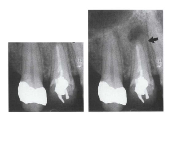 Radiographs in endodontics | PDF | Dental Health | Diseases and Conditions