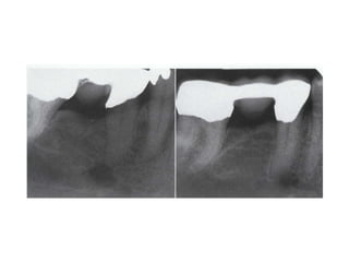 Radiographs in endodontics | PDF