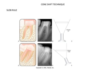 Radiographs in endodontics | PDF