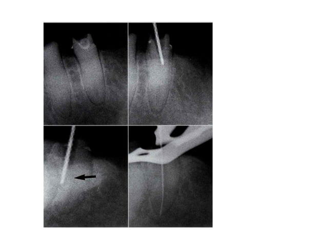 Radiographs in endodontics | PDF | Dental Health | Diseases and Conditions