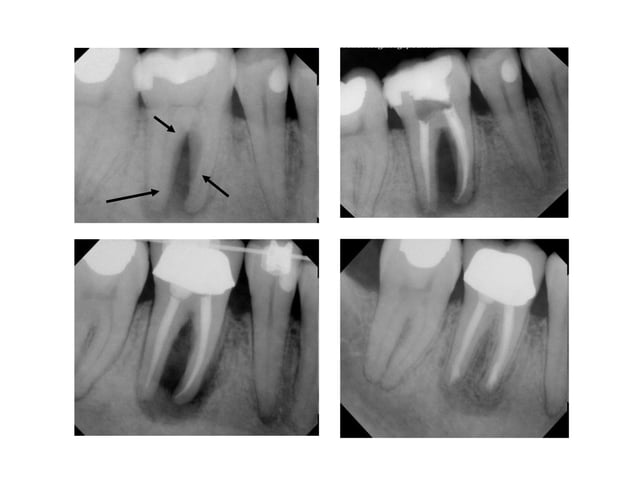 Radiographs in endodontics