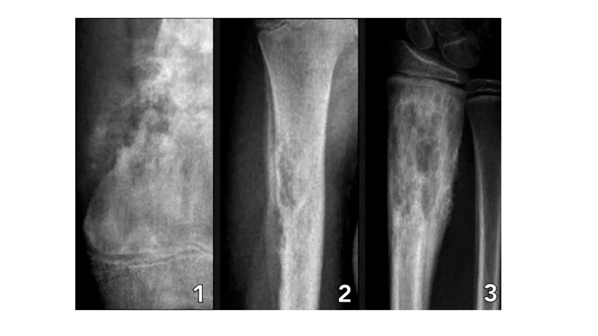 Approach to MSK tumor radiology.pptx | Bone and Joint Conditions ...