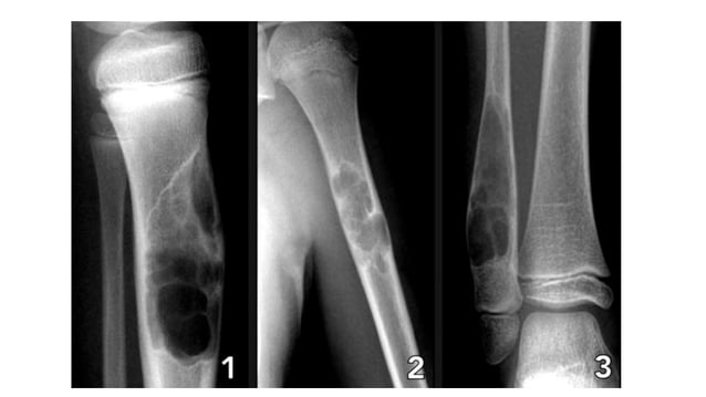 Approach to MSK tumor radiology.pptx | Bone and Joint Conditions ...