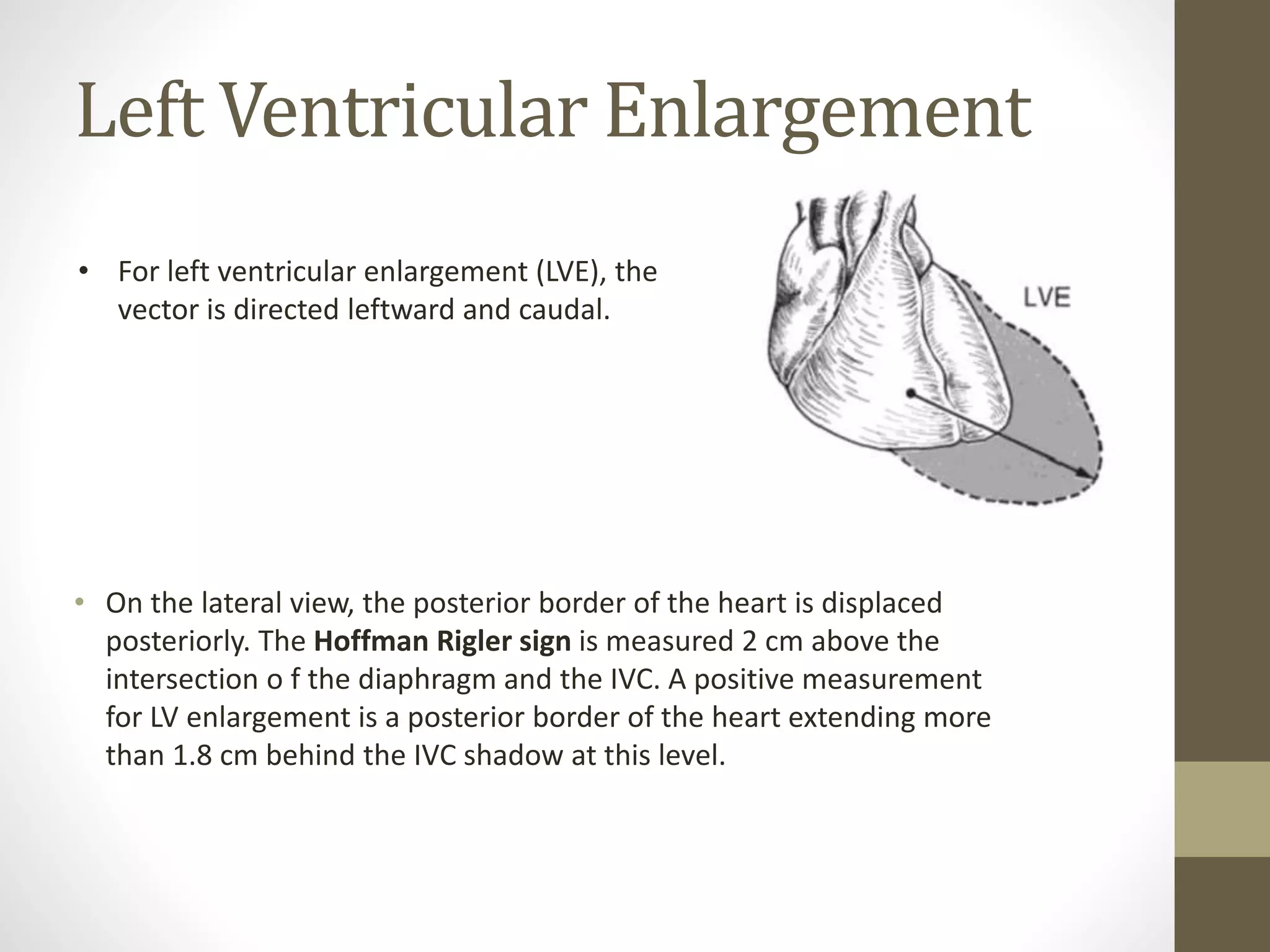 Radiography of acquired Heart Disease.pptx