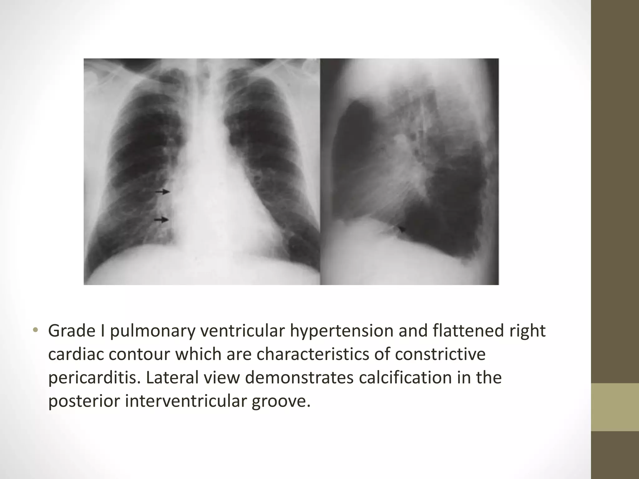 Radiography of acquired Heart Disease.pptx