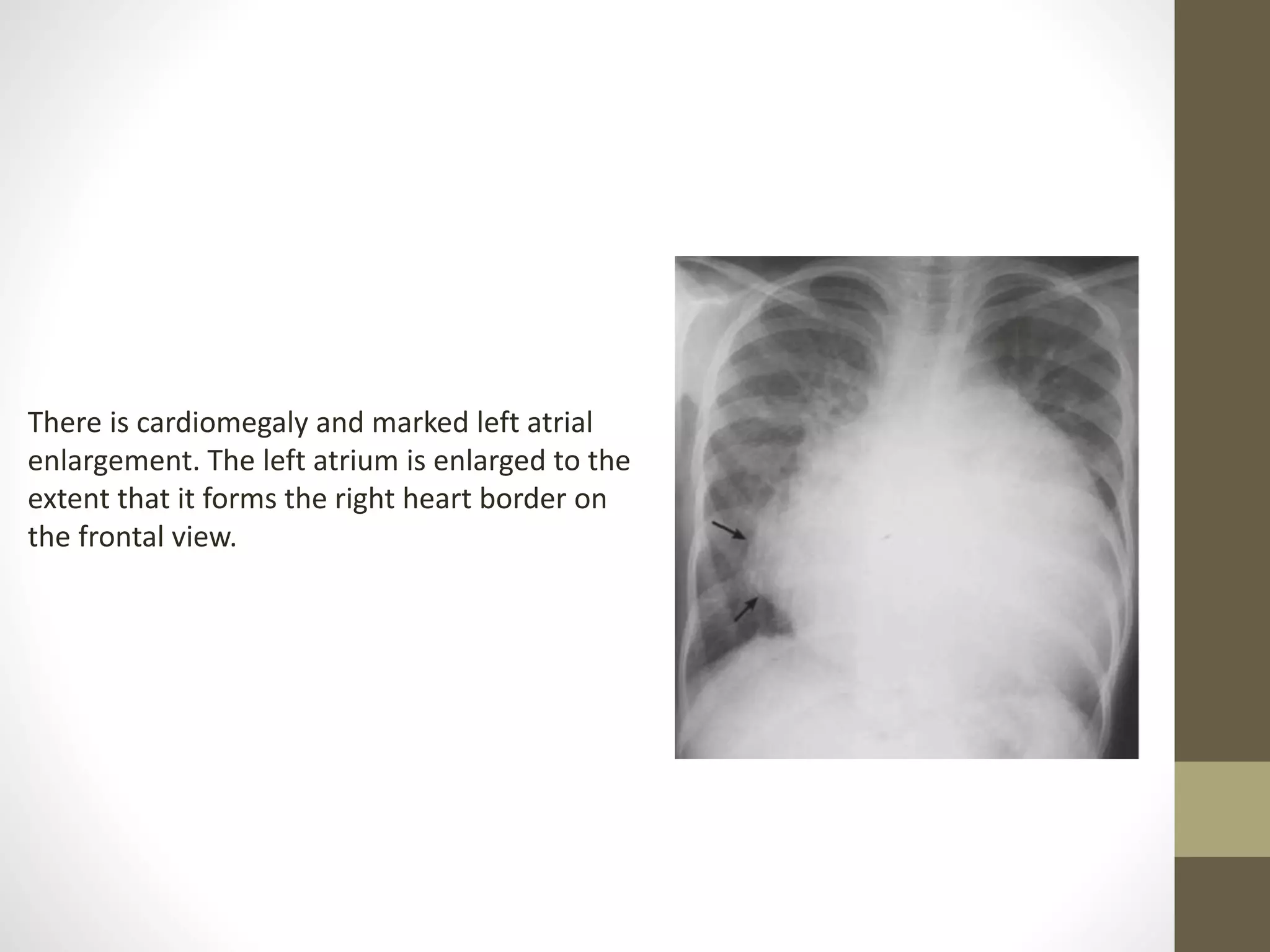 Radiography of acquired Heart Disease.pptx