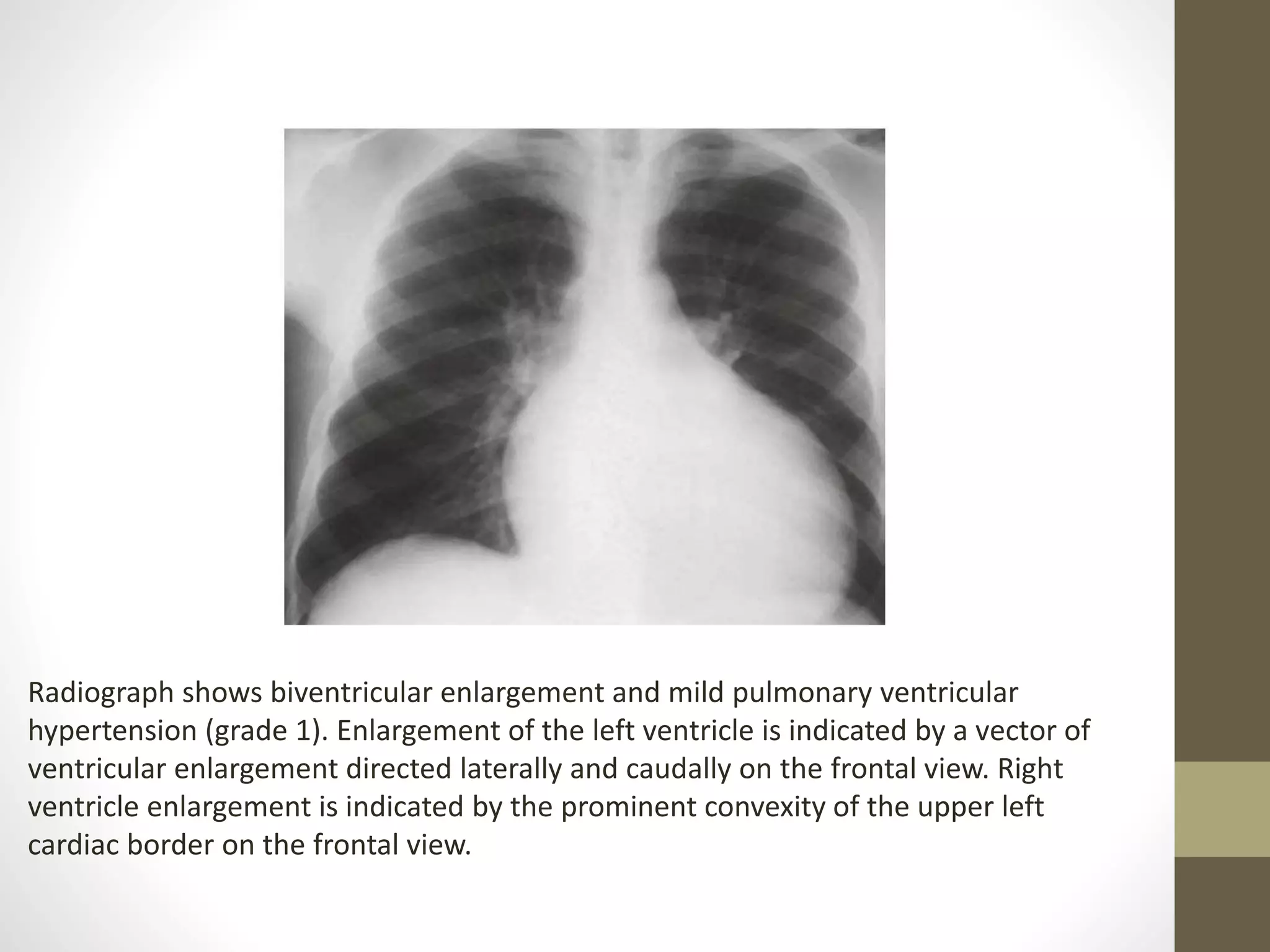 Radiography of acquired Heart Disease.pptx