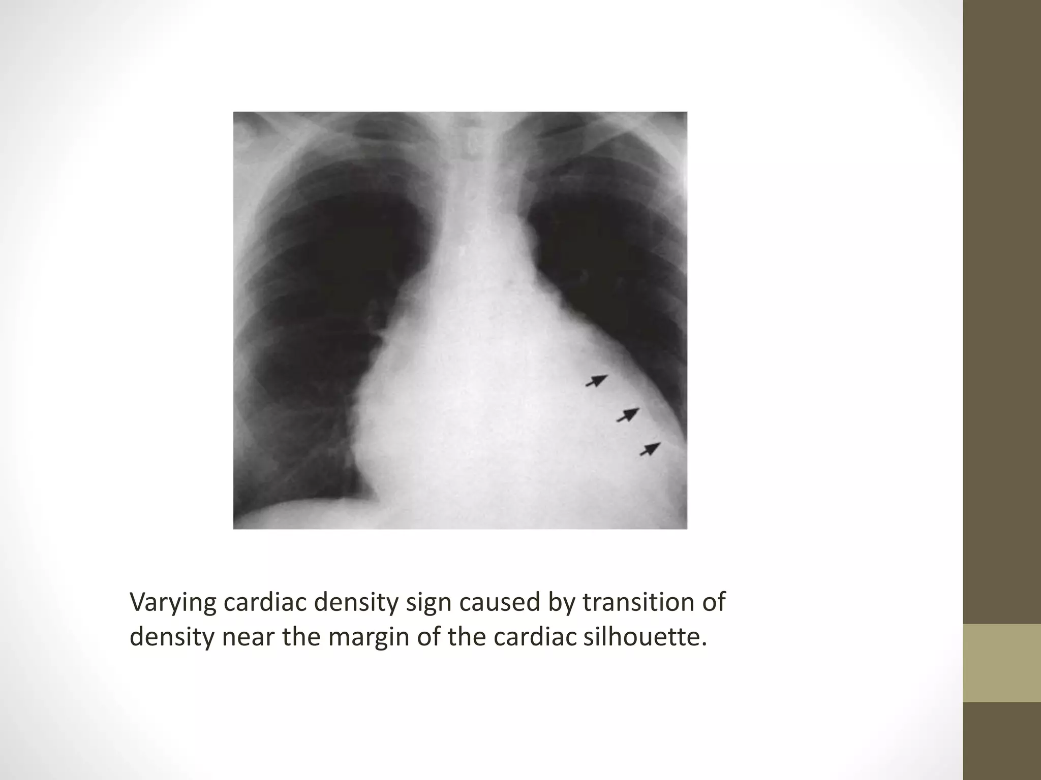 Radiography of acquired Heart Disease.pptx