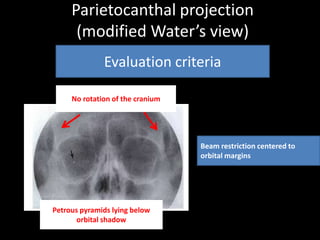 Radiography of eye | PPTX