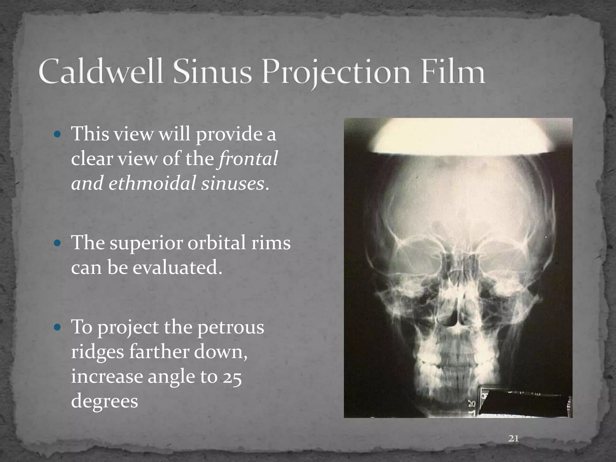 Radiography and Anatomy of orbit | PPTX
