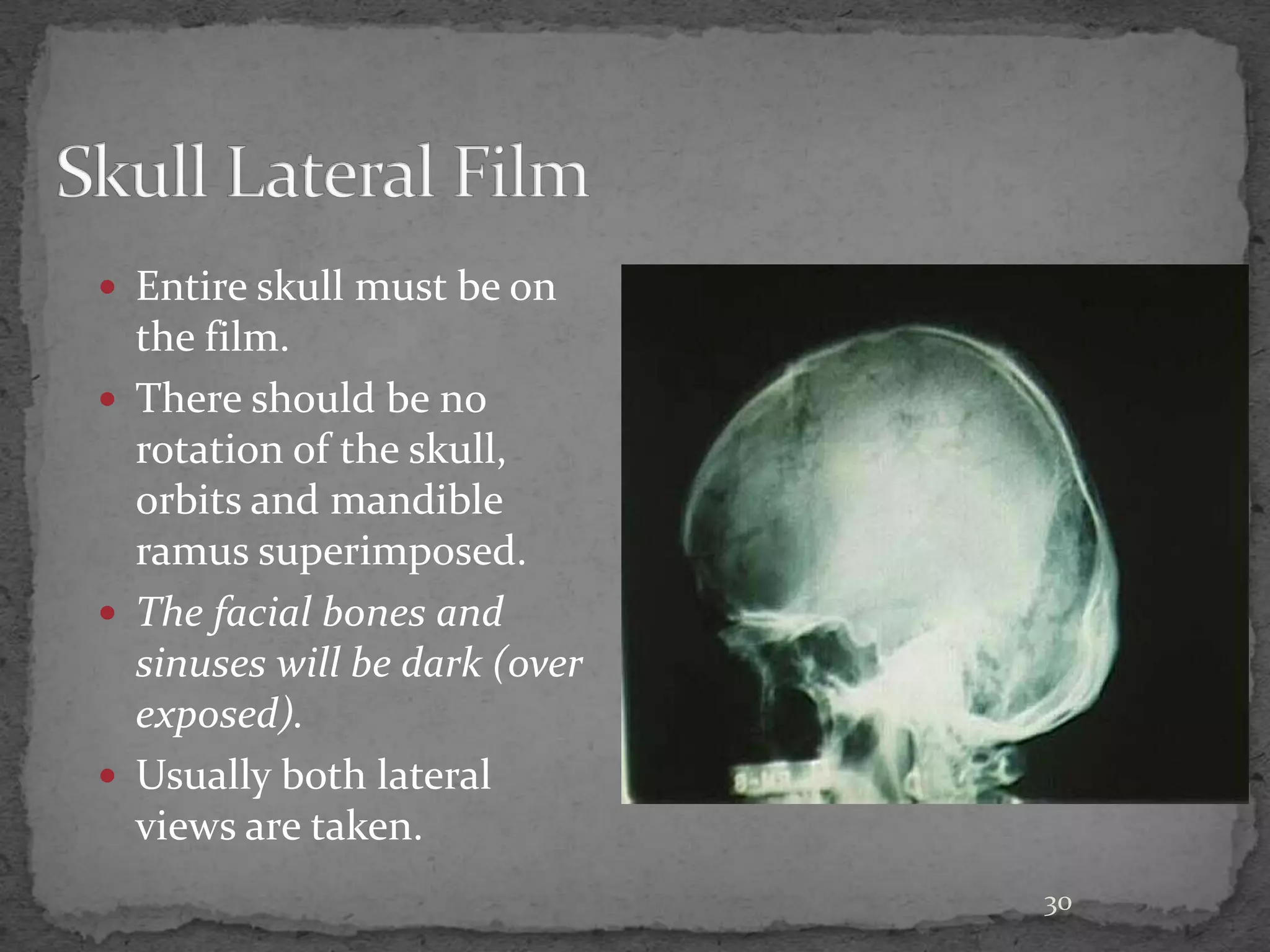 Radiography and Anatomy of orbit | PPTX