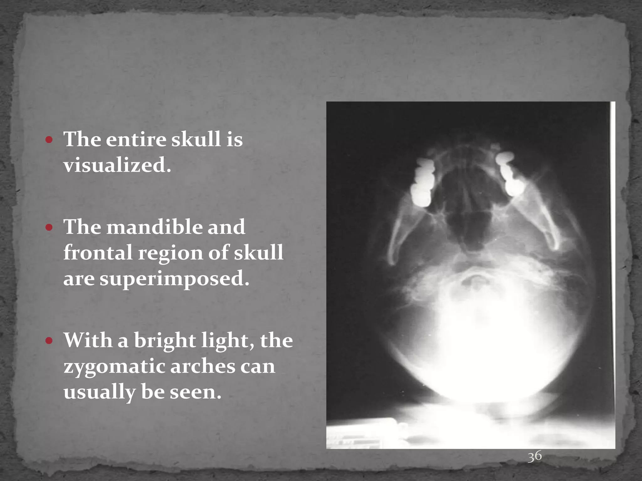 Radiography and Anatomy of orbit | PPTX