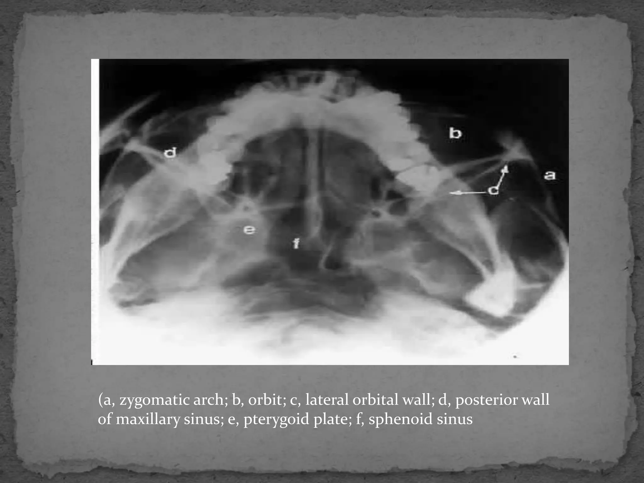 Radiography and Anatomy of orbit | PPTX