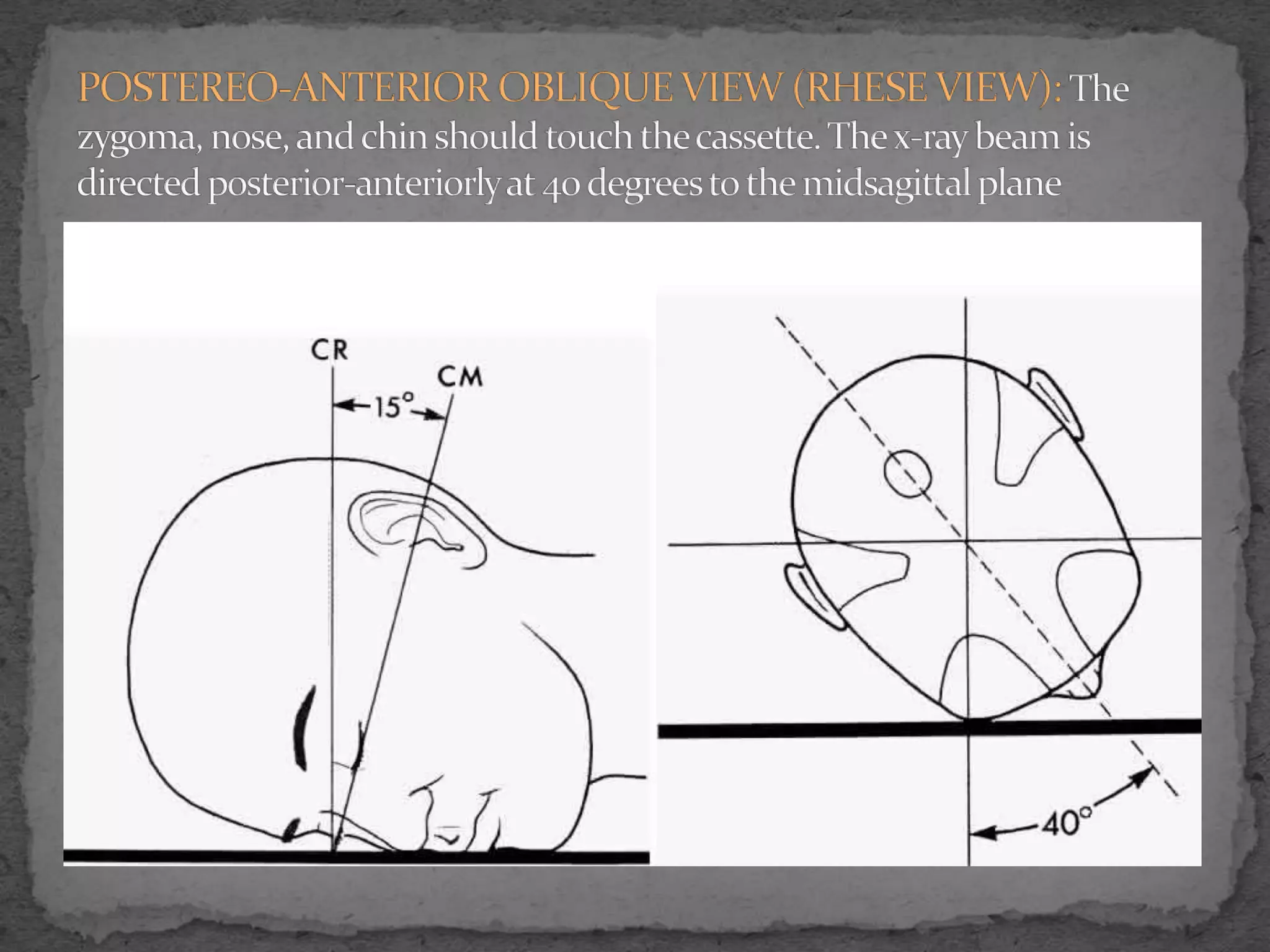 Radiography and Anatomy of orbit | PPTX