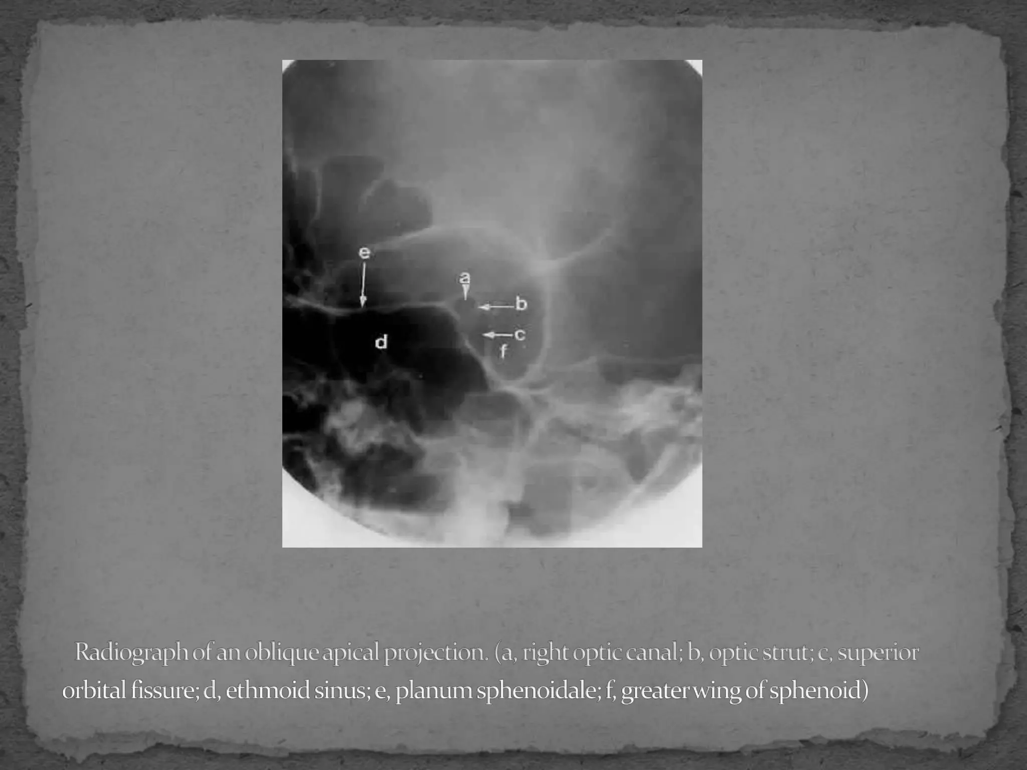 Radiography and Anatomy of orbit | PPTX