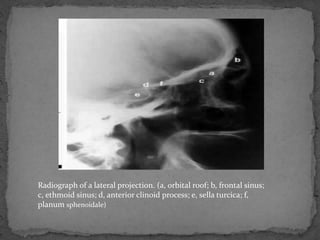 Radiography and Anatomy of orbit | PPTX