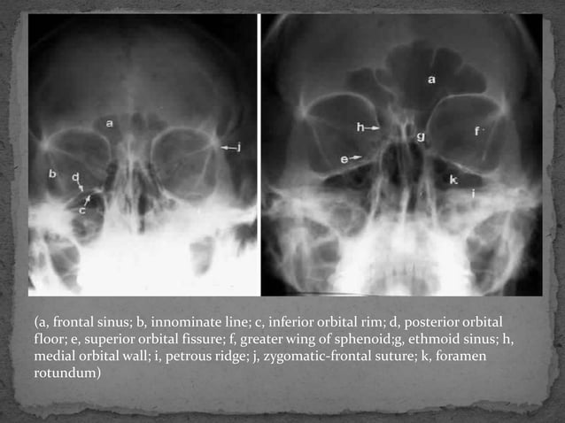 Radiography and Anatomy of orbit