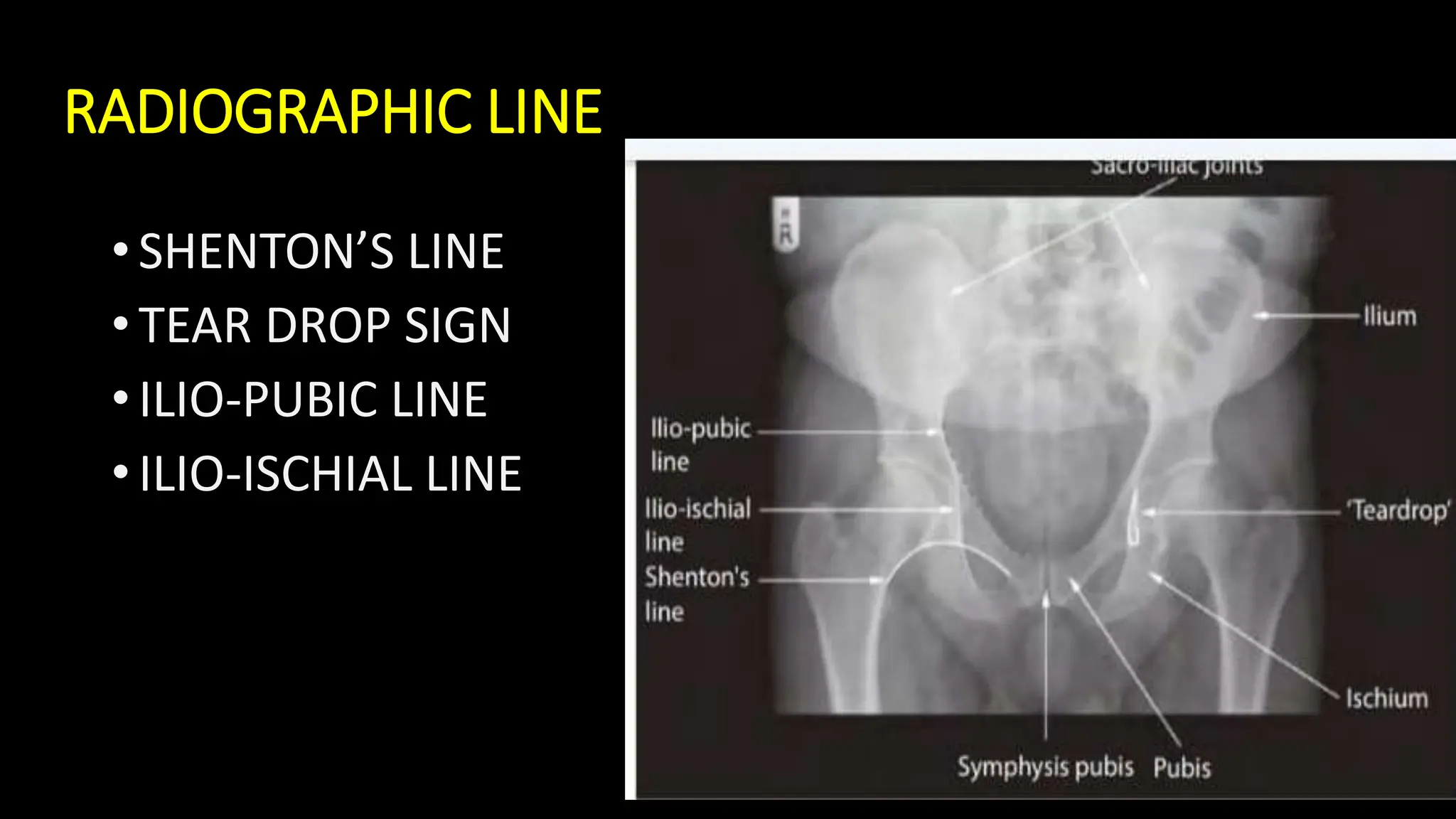 Radiography of Pelvis & Hip Joints - Saroj.pptx