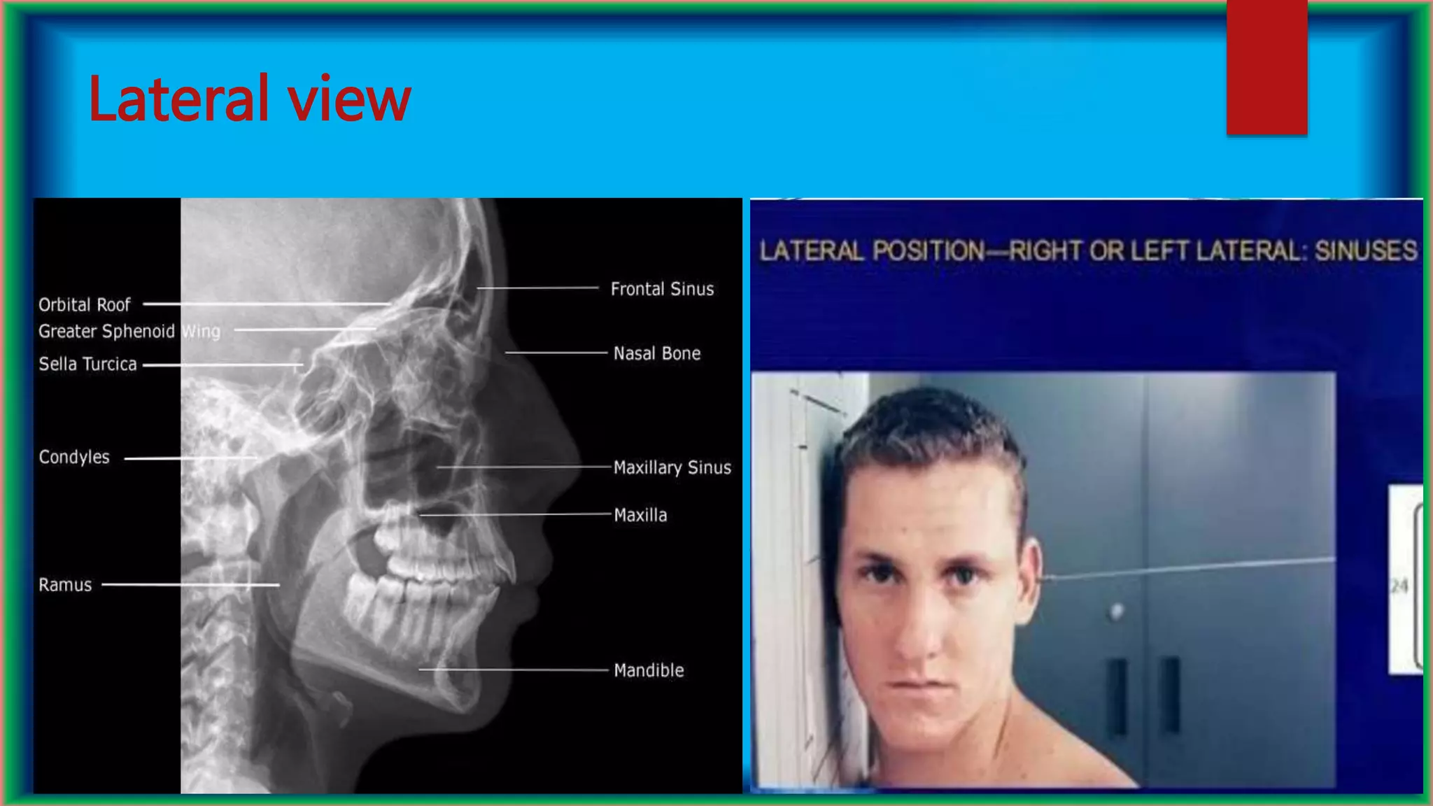 radiography of PNS.pptx