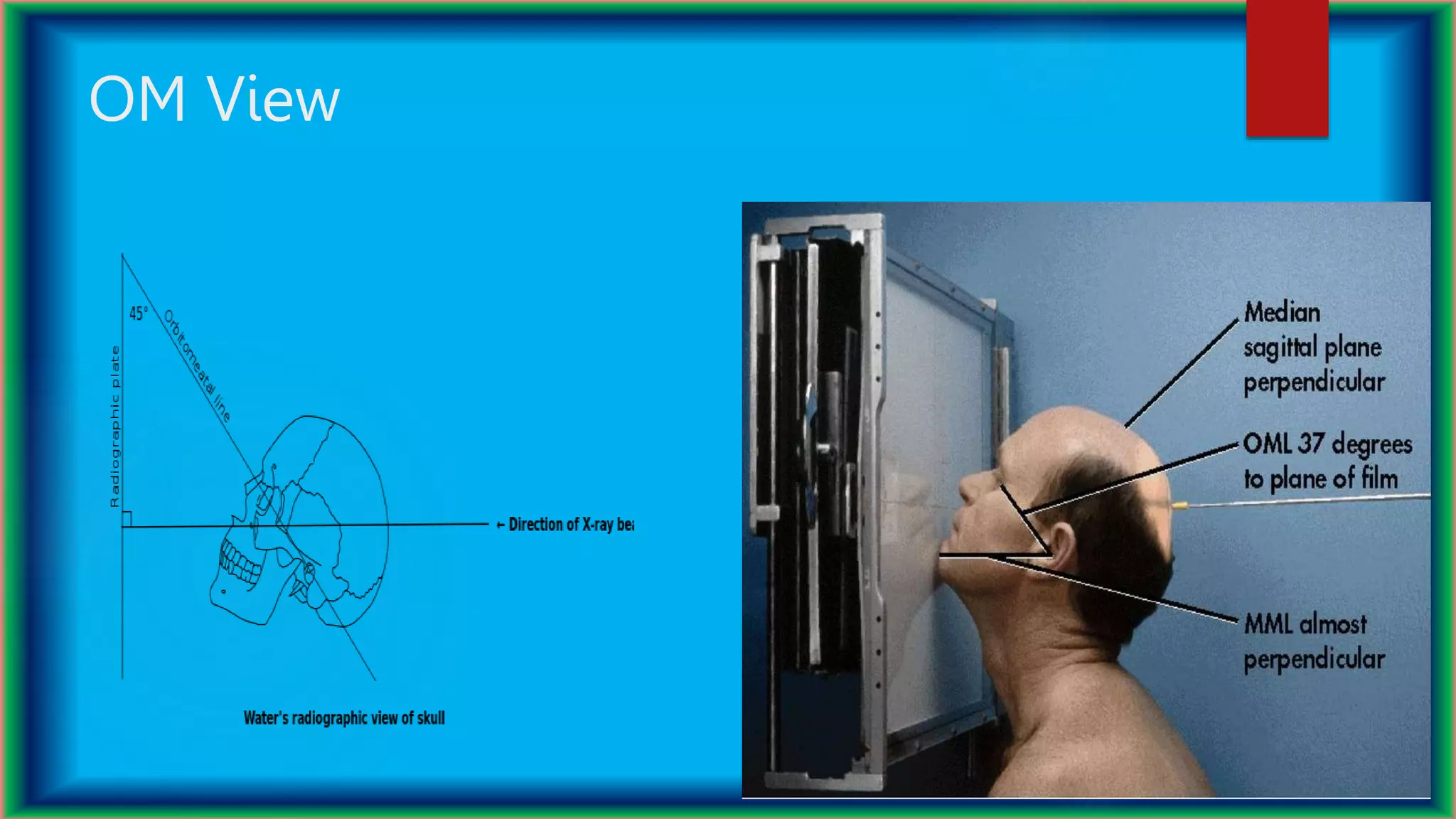 radiography of PNS.pptx