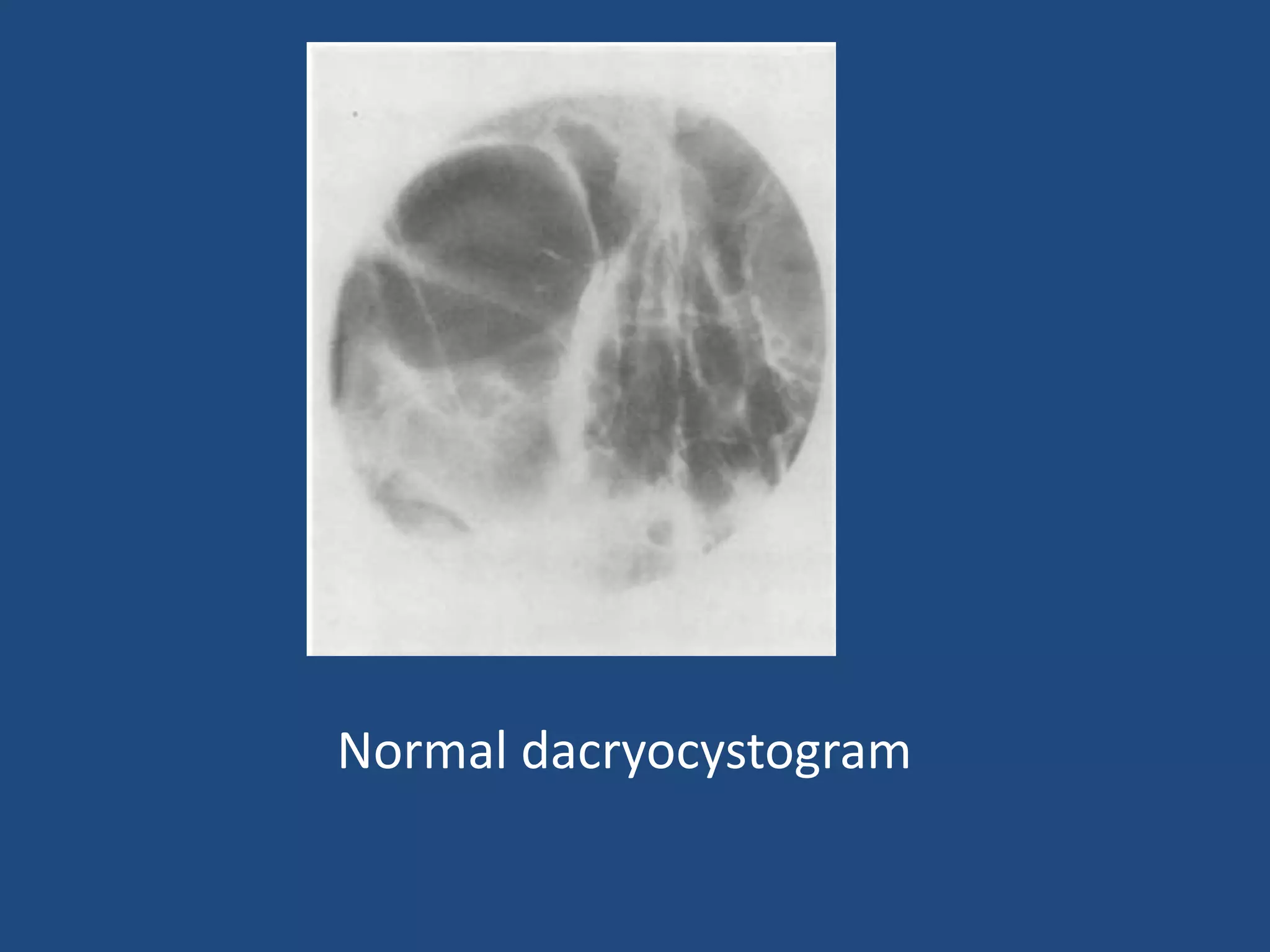 Radiography round on dacrocystography | PPTX