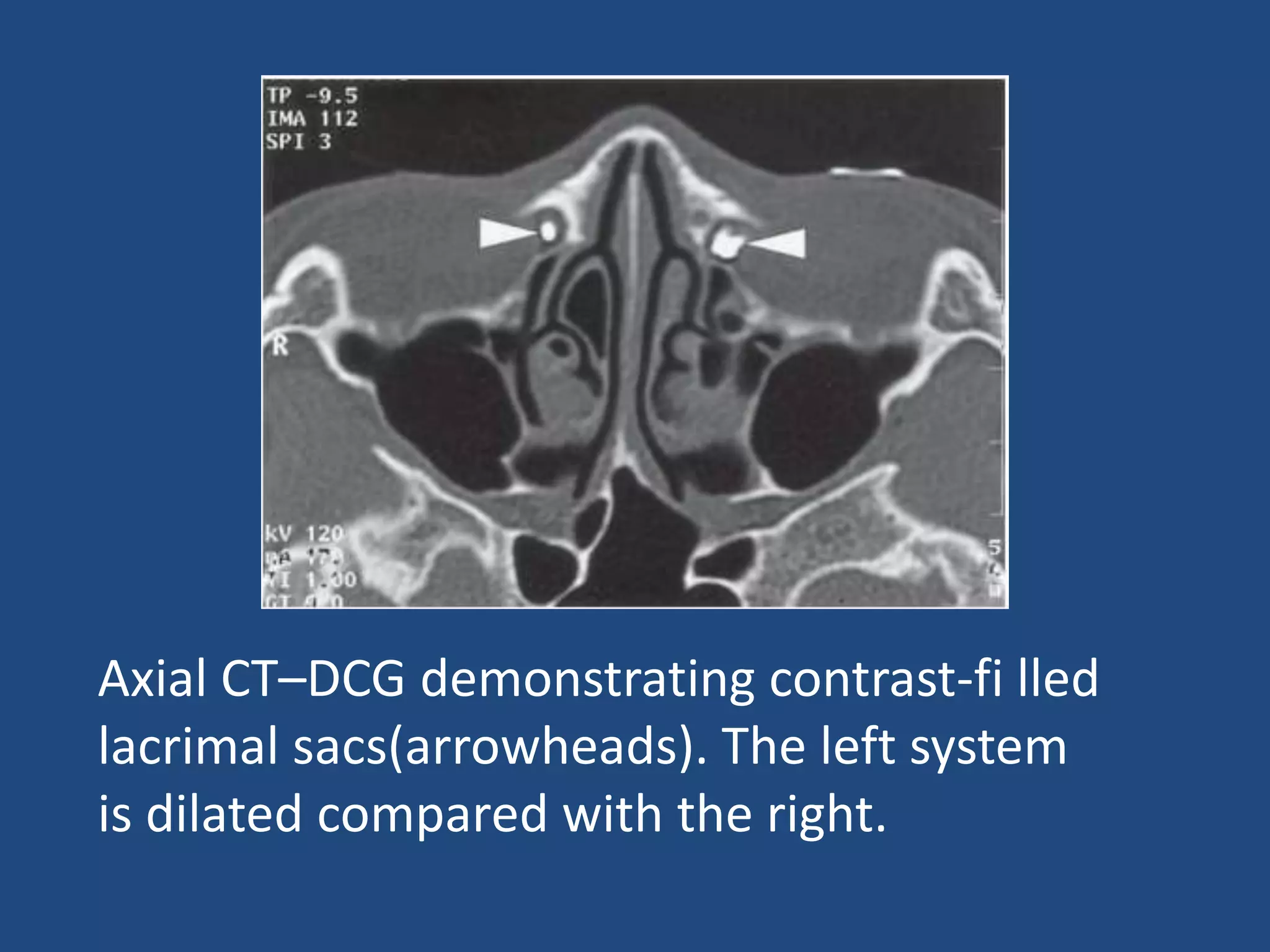 Radiography round on dacrocystography | PPTX