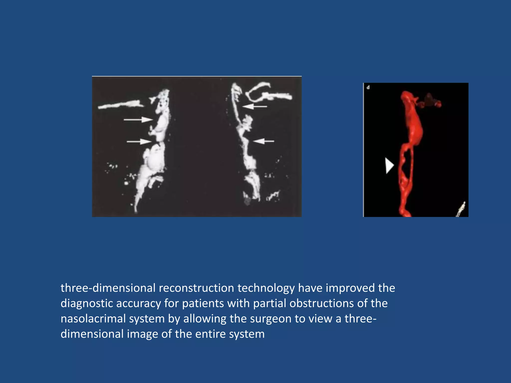 Radiography round on dacrocystography | PPTX
