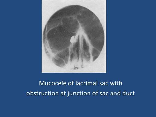 Radiography round on dacrocystography | PPTX | Ear, Nose and Throat ...