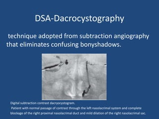 Radiography round on dacrocystography | PPTX