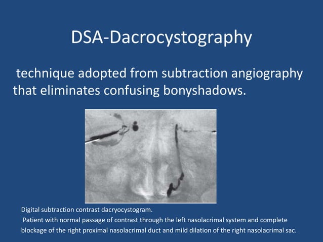 Radiography round on dacrocystography | PPTX | Ear, Nose and Throat Conditions | Diseases and ...