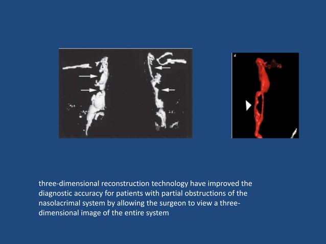 Radiography round on dacrocystography | PPTX | Ear, Nose and Throat ...