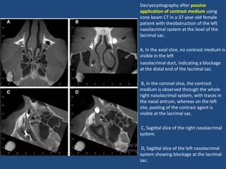 Radiography round on dacrocystography | PPTX