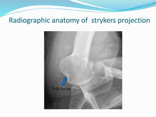 Radiograpic views for shoulder joint | PPTX