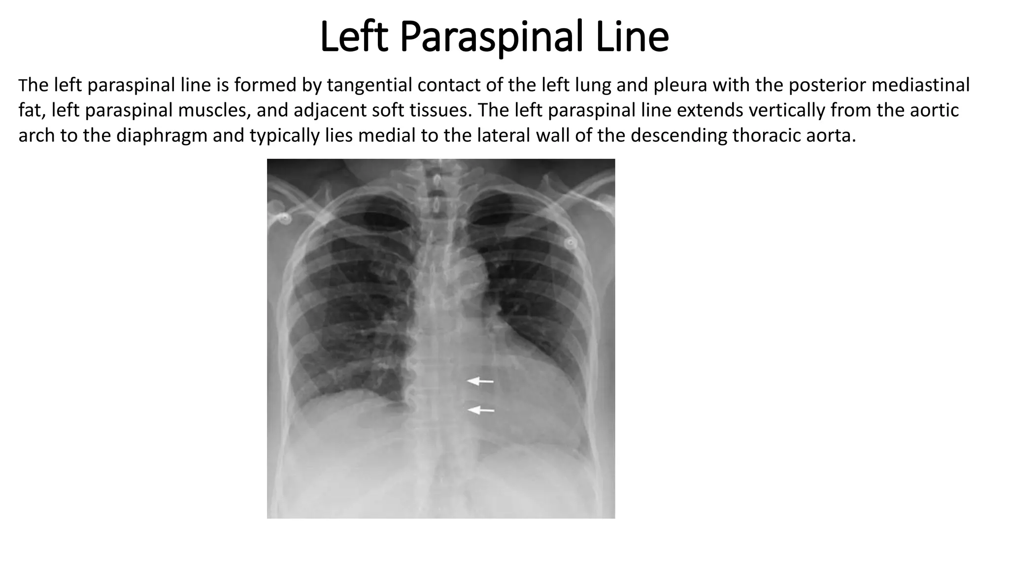 RADIOIMAGING IN MEDIASTINAL MASSES YN.pptx