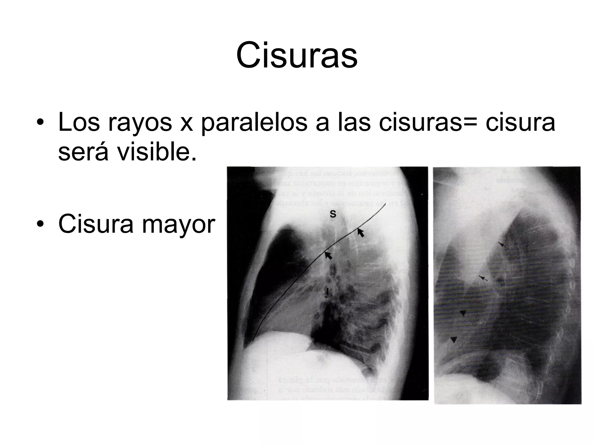 RadiologíA De TóRax Normal | PPT | Lung and Respiratory Health ...