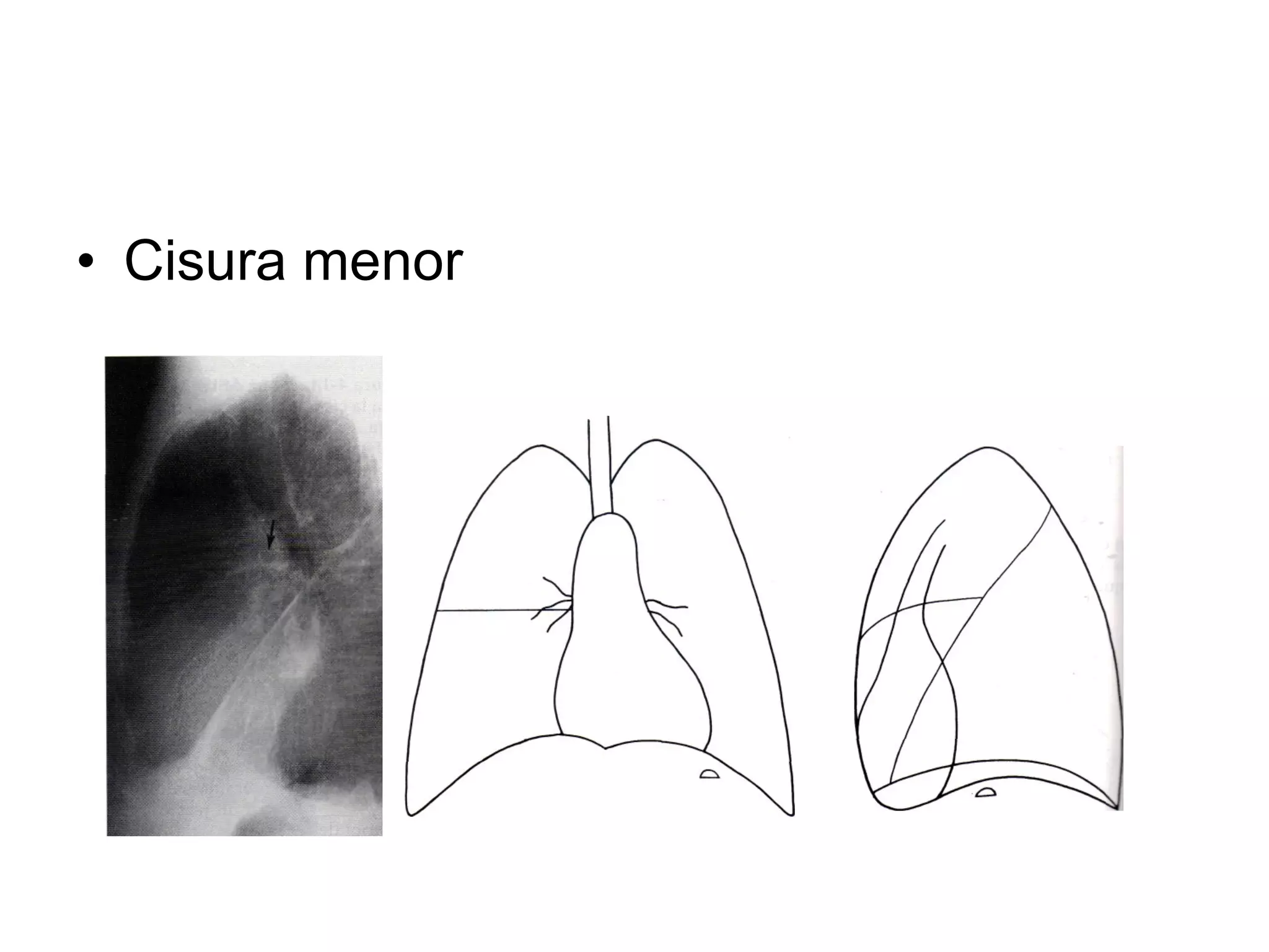 RadiologíA De TóRax Normal | PPT | Lung and Respiratory Health ...