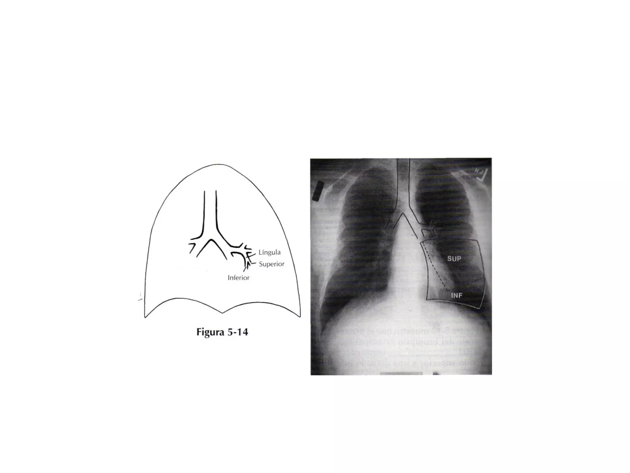 RadiologíA De TóRax Normal | PPT | Lung and Respiratory Health ...