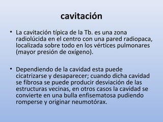 Radiología de la tuberculosis | PPT