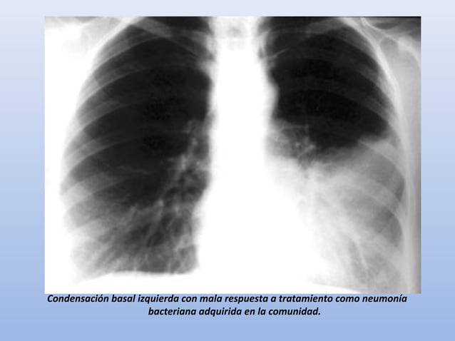 Radiología de la tuberculosis